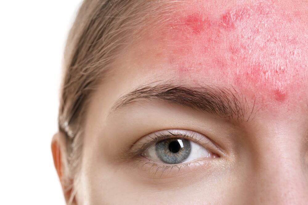 Learn How To Treat Acne Rosacea Key Differences To Acne Learn How To Treat Acne Rosacea Key Differences To Acne